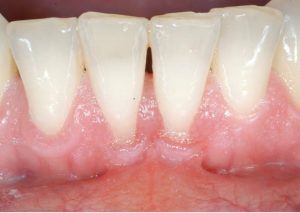 Guided Tissue Regeneration – Bonacci Periodontal Implants